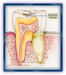 Kako nastaje karijes - Stomatologija.info